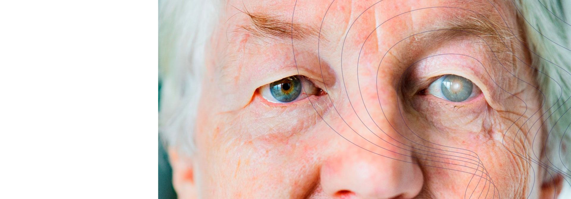 Catarata - Visão em dia